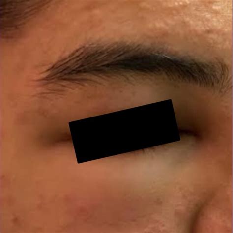 Mildly Erythematous Scaly Papules Coalescing On Forehead Temple And Download Scientific