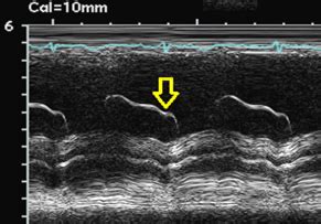 Echo Midterm Flashcards Quizlet