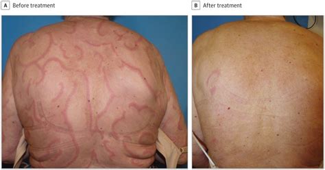 Jama Dermatology On Linkedin Treatment Of Eosinophilic Annular