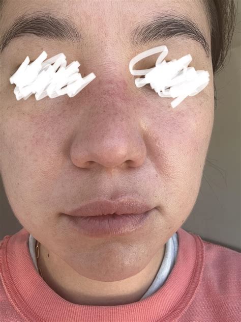 help more and more broken capillaries and diffuse redness as i age terrified of lasers but