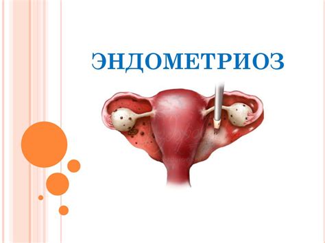 Эндометриоз презентация онлайн