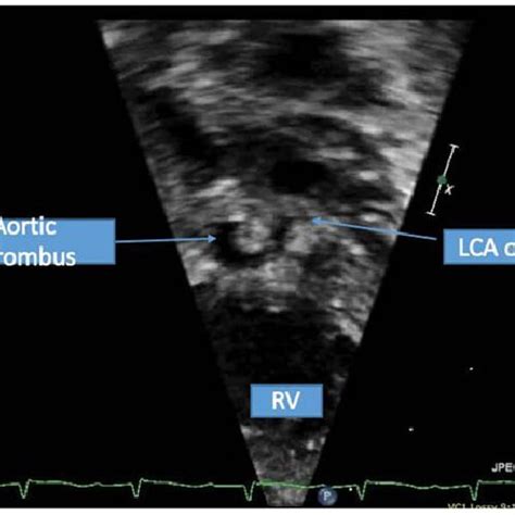 Short Axis Of The Aortic Root With Echogenic Mass Noted In Native Download Scientific Diagram