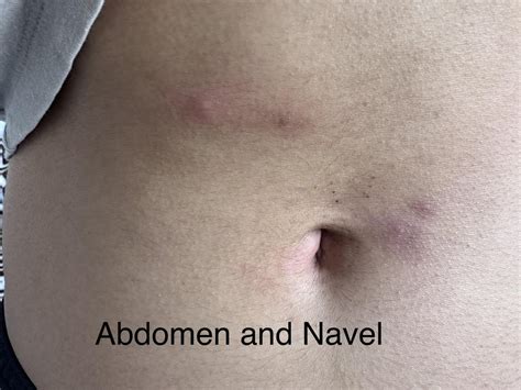 Help Scabies R Scabies