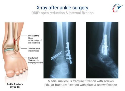 Soccer Sport Science Injuries Lower Limb Ankle And Foot Ankle Fracture Assic Education