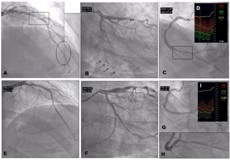 Angina Module 7 Revascularisation In Stable Coronary Artery Disease