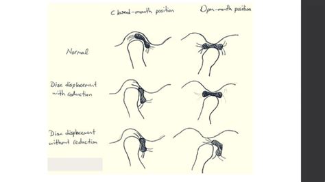 Temporal Mandibular Disorders Summary For Dental Students Ppt