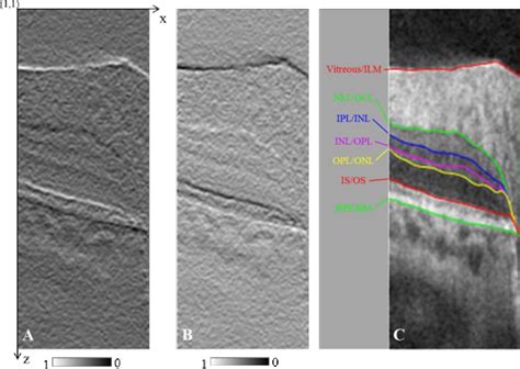 Figure 1 From Automated Boundary Detection Of The Optic Disc And Layer Segmentation Of The