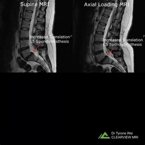 Acquired Lumbar Central Canal Spinal Stenosis Facet Joint Effusion And