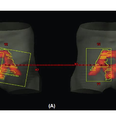 a a suboptimal multi leaf collimator mlc segment in volumetric