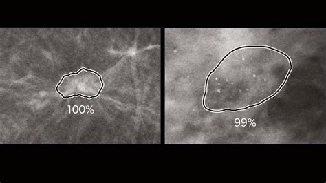 History Of Computer Aided Detection Cad