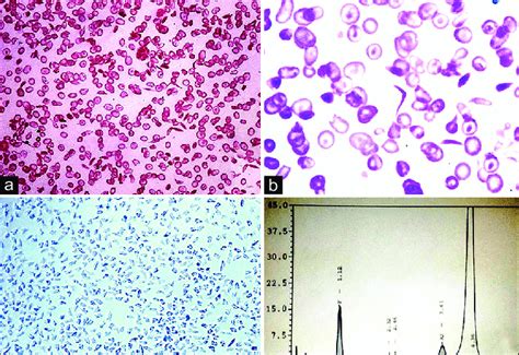 Reticulocyte Wright Stain