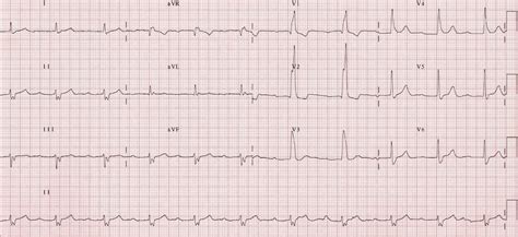 Trifascicular Block • Litfl • Ecg Library Diagnosis