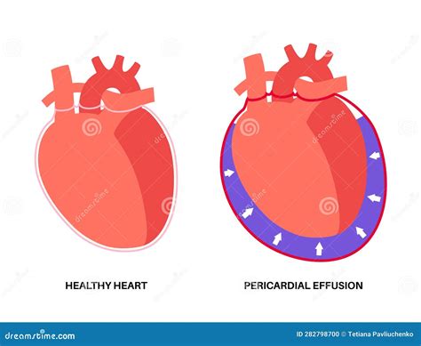 Pericardial Effusion Heart Cartoon Vector 280424863