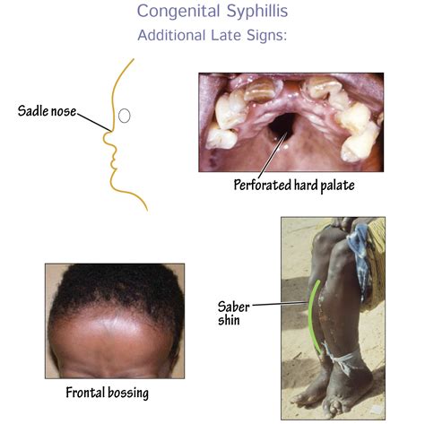 Neonatal Syphilis Congenital Syphilis Diagnosis And Management