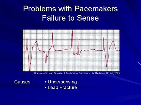 Pacemakers Outline 1 Pacemaker Codes 2 Pacemaker Configurations