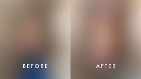 Penis Enlargement Surgery Before And After