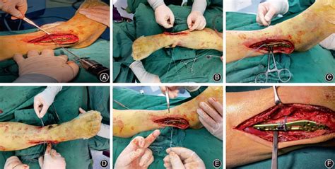 Analysis Of The Operation Of Inferior Tibiofibular Fixation With Nice Download Scientific