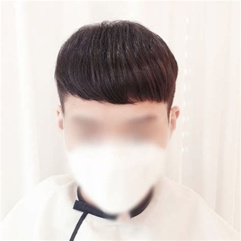 M자 탈모 초기 남자 헤어스타일 헤어증모술 전 후 비교 네이버 블로그