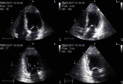 Understanding Echocardiograms Cardiacsolutions