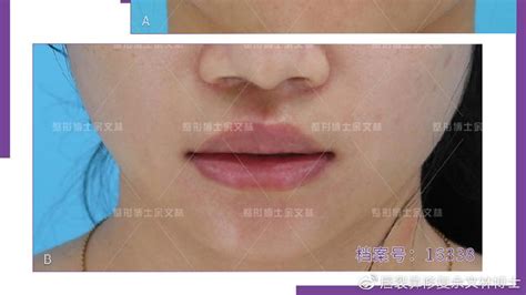 兔唇（唇裂）第二次修复手术，多久可以见效？ 知乎