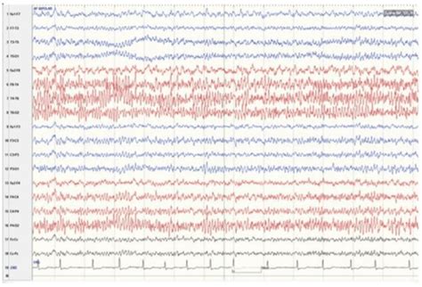 Eeg Fun Facts Alice In Wonderland Syndrome Aiws May 31 2024