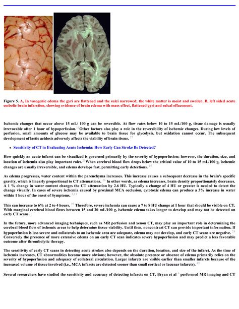 Topic Of The Month Neuroimaging Of Embolic Cerebral Infarctions Pdf