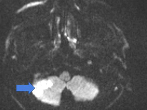 Vertigo And Ischemic Stroke After Hyperextension Beauty Parlour Stroke