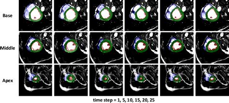 Msu Net Multiscale Statistical U Net For Real Time 3d Cardiac Mri Video Segmentation