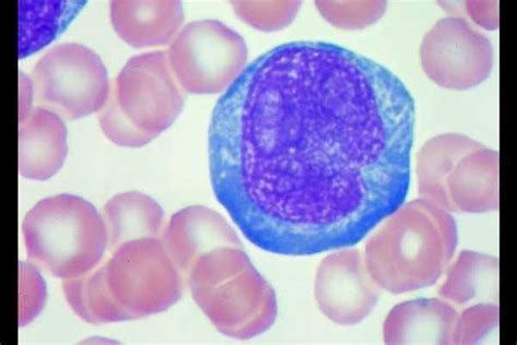 Plasmacytoid Lymphocyte Medical Laboratories