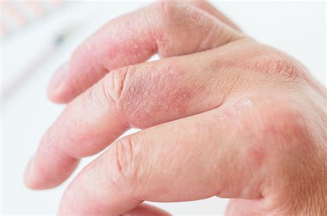 Eczema Vs Psoriasis How To Tell The Difference Assurance Skin