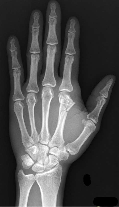 scaphoid scanner object detection dataset and pre trained model by