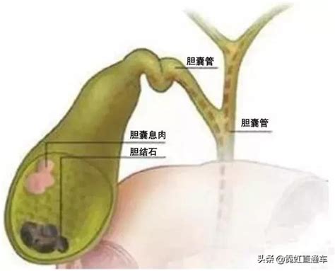 體檢查出結節、息肉、囊腫、增生哪個才是癌症的先兆？ 每日頭條