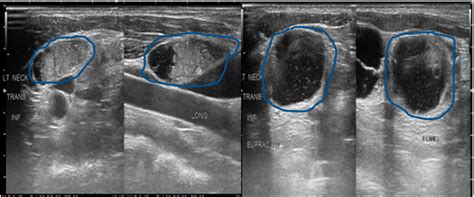 Normal Vs Abnormal Thyroid Ultrasound Ultrasound Findings Of The