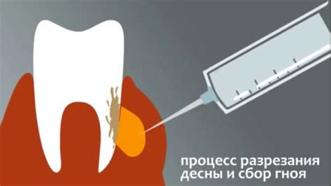 Флюс Лечение флюса - YouTube