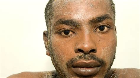 Mild Psoriasis On Face