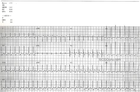 Paroxysmal Supraventricular Tachycardia Ecg Guru Instructor Resources