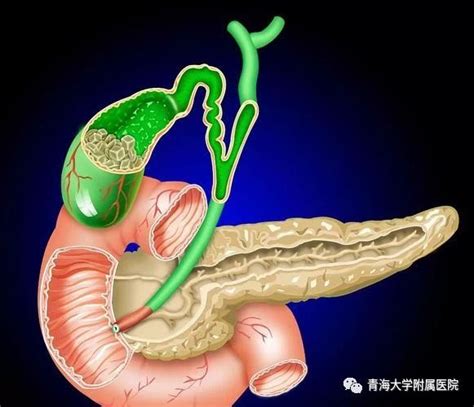 慢性胆囊炎你了解多少 青海大学附属医院