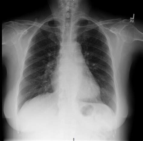 Histoplasmosis Lung X Ray