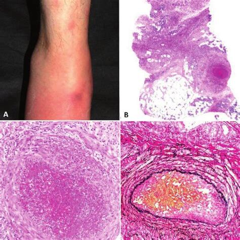 Clinicopathological Features Of An Erythema Nodosum Type Lesion Case Download Scientific
