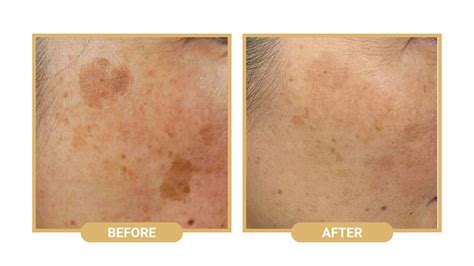 Best Pico Laser In Malaysia NextMed Clinic