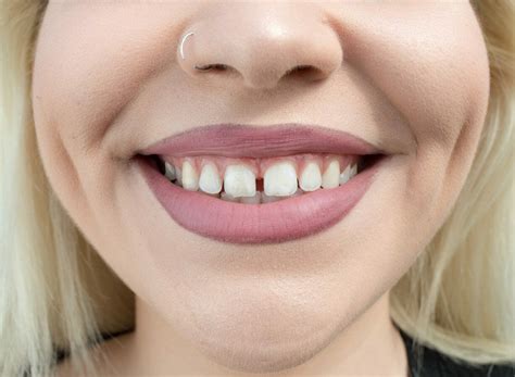causes and treatment options for gap teeth diastema