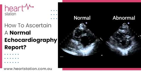 Normal Vs Abnormal Echocardiogram Echocardiography In The Evaluation
