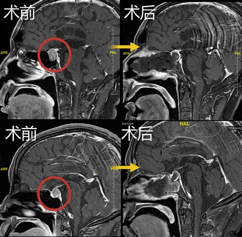 石景山院区神经外科经鼻内镜手术完成垂体腺瘤治疗 医院新闻