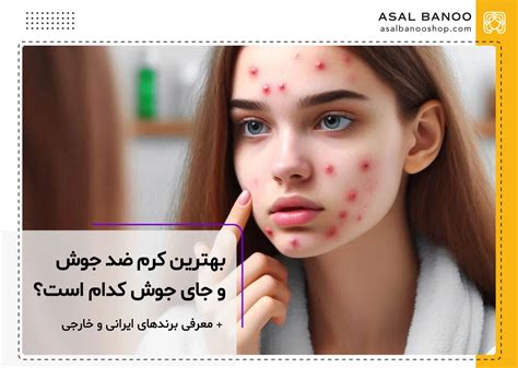 بهترین کرم ضد جوش و جای جوش ایرانی و خارجی 5 محصول