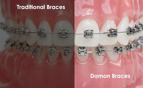 Damon System Braces Vs Traditional Braces Damon System Braces By Dsb