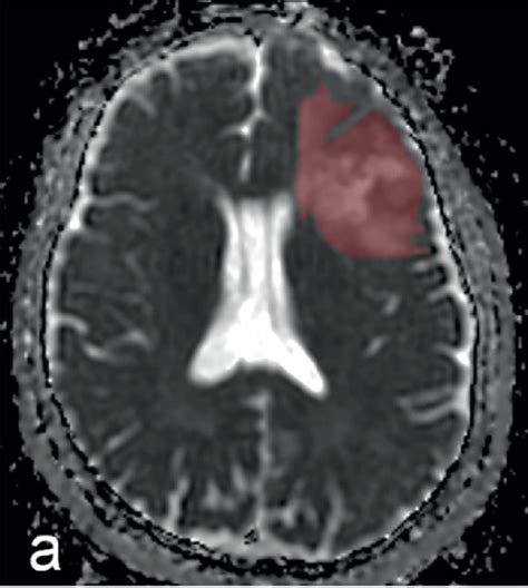 Freehand Segmentation Of Idh Mutant With 1p19q Co Deleted Lgg A Download Scientific