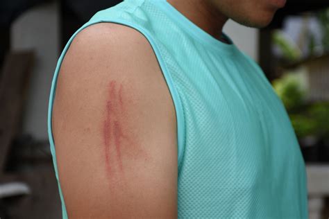 Doctors Warn Bali Travelers About Rash Caused By Contact With Toxic Insect The Bali Sun