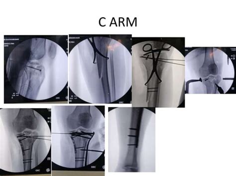 Proximal Tibia Fracture PPT