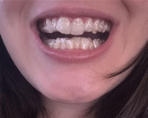Not Done Yet But First Set Ever Vs First Set Of Refinements 😄 R Invisalign
