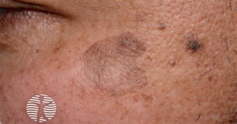 Solar Lentigo Image